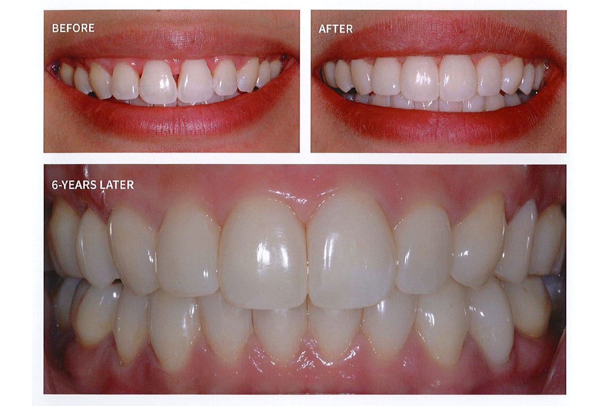 Bioclear in Edmonton, AB | Davinci Smiles Dental Clinic